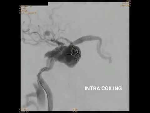Endovascular Coiling for High Flow Carotid Cavernous Fistula - YouTube