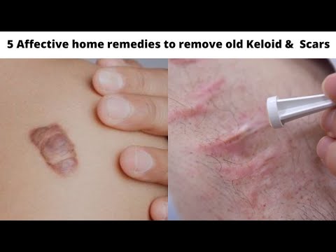 5 Affective home remedies to remove old Keloid and Scars | Natural Cure ...
