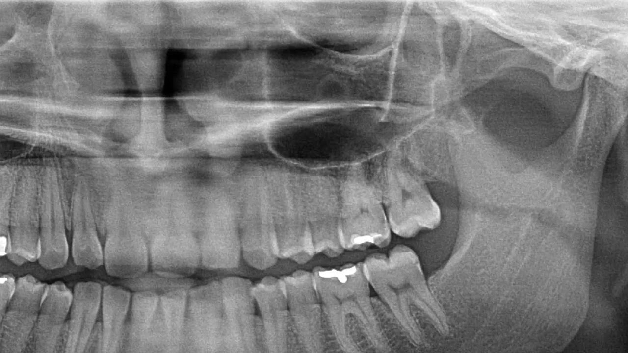 Quiz A circular radiopacity - YouTube