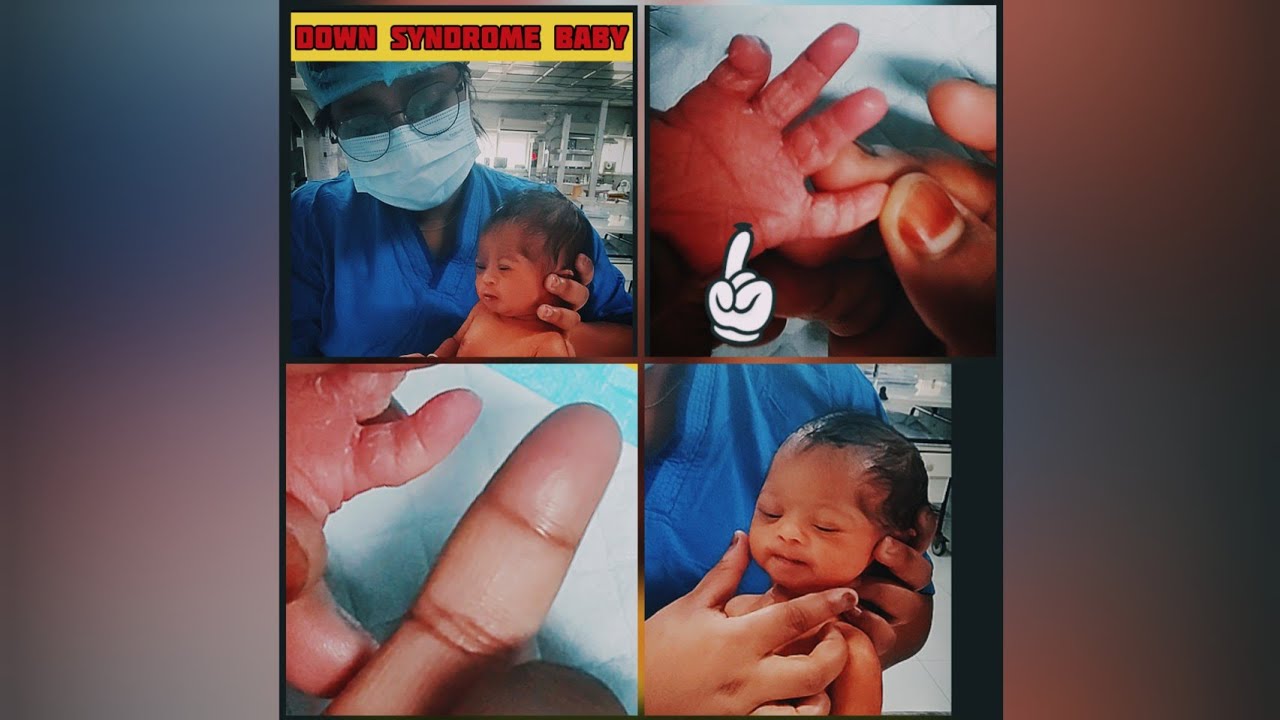 Down Syndrome Baby.Trisomy 21.Chromosomal Abnormalities. - YouTube