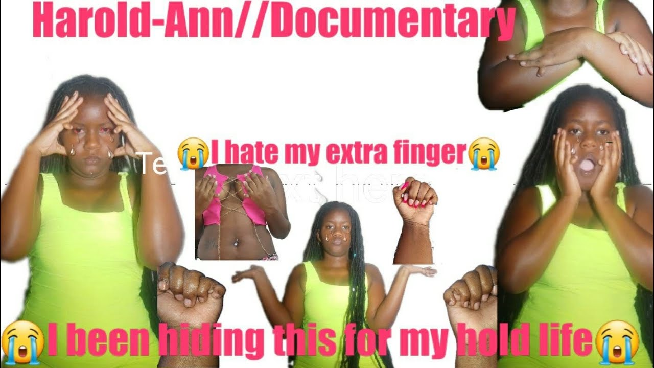 Harold-Ann Samuel Documentary/My Story About My Extra Finger😱😳😳Who Is ...
