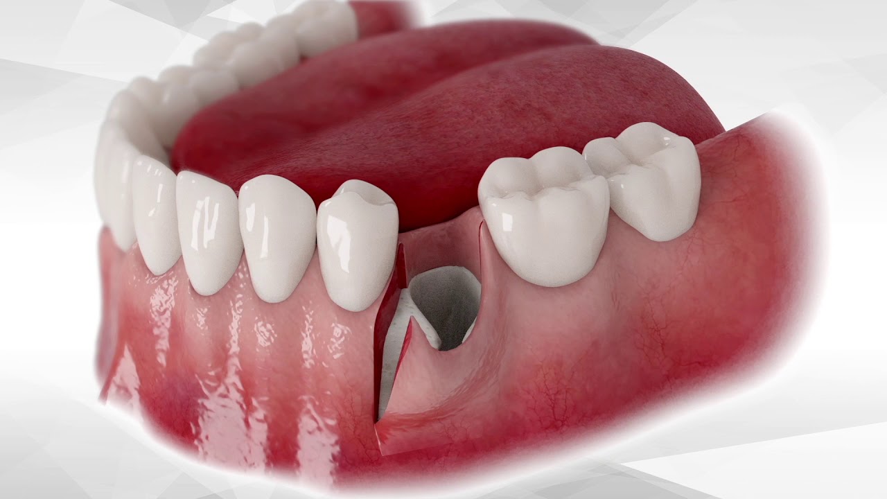 Best bone graft 3D Bond protocol for socket grafting with flap ...