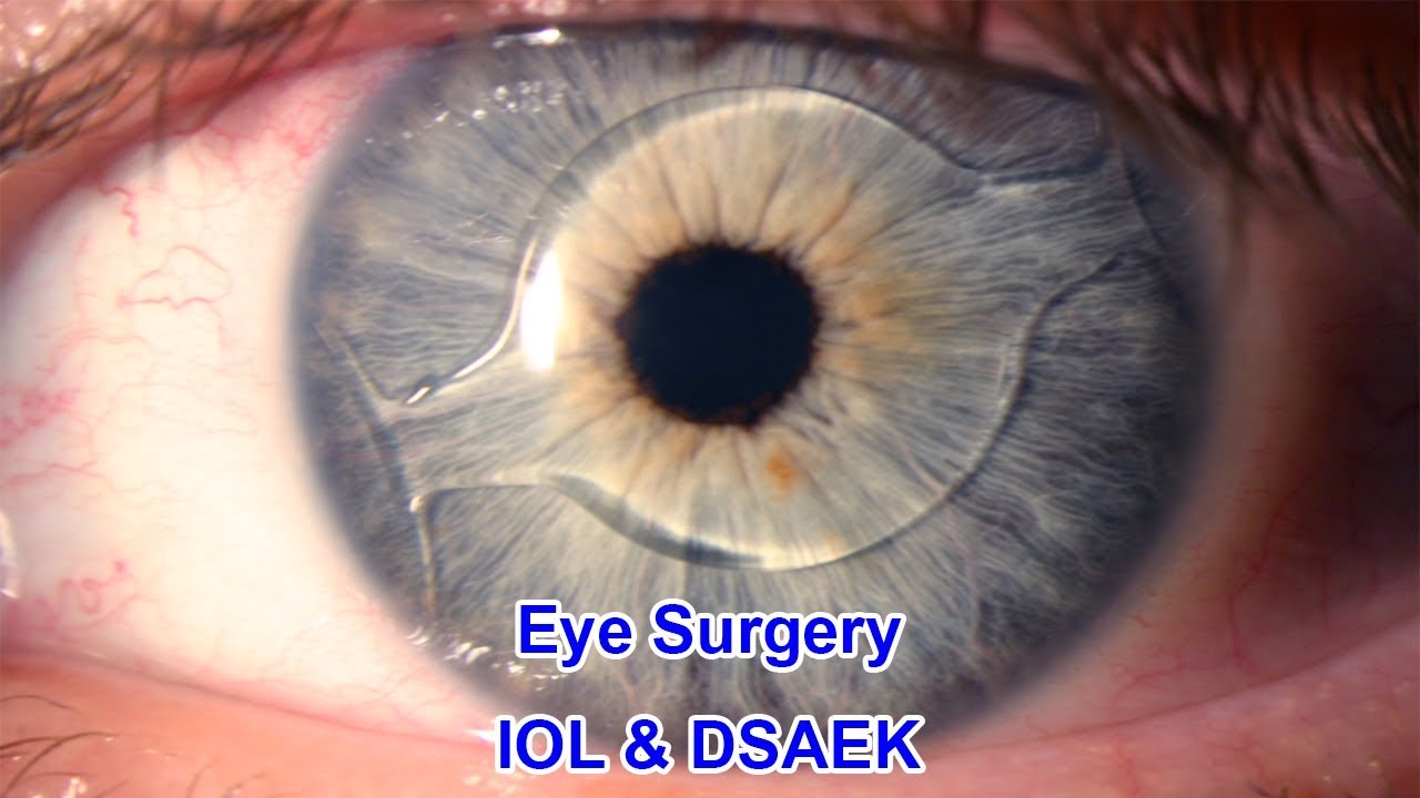 Intraocular Lens Exchange & Descemet's Stripping Automated Endothelial ...