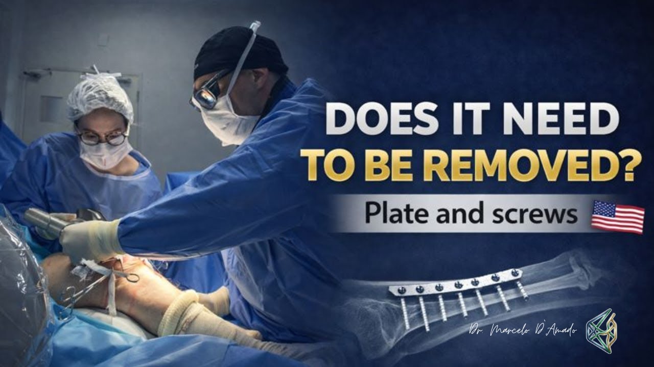 Removal of plates and screws: When is it necessary to remove orthopedic ...