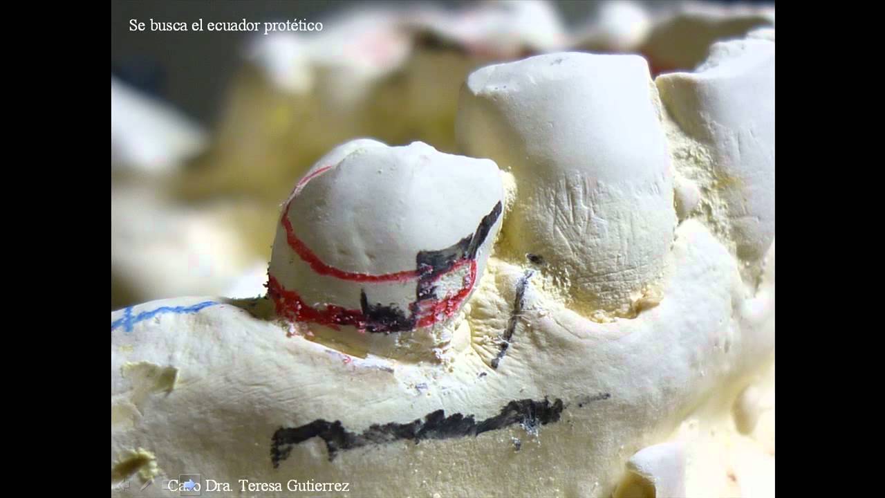 Paralelizado en PPR- Diagnóstico en PPR - YouTube