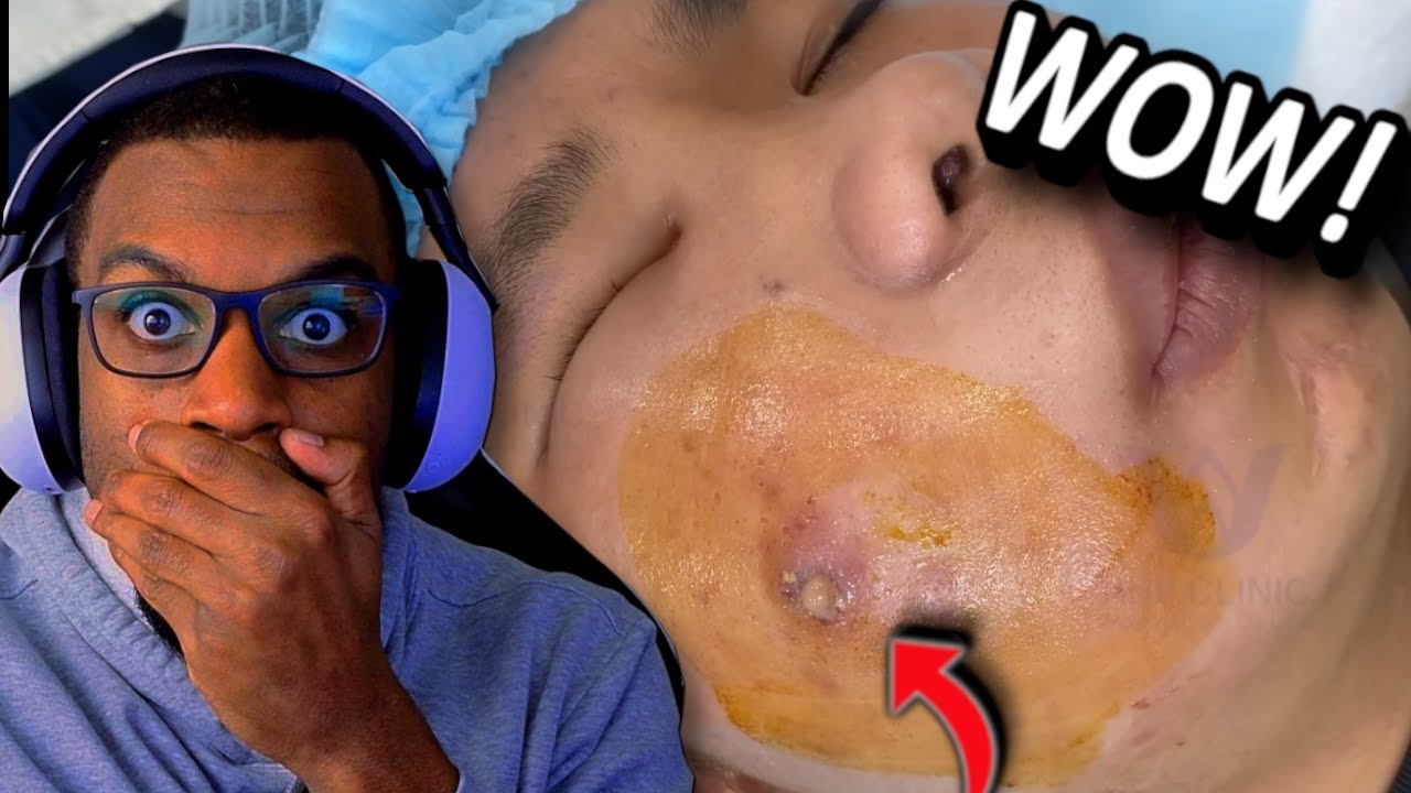 Massive Face CYST THAT WILL SHOCK YOU! - YouTube