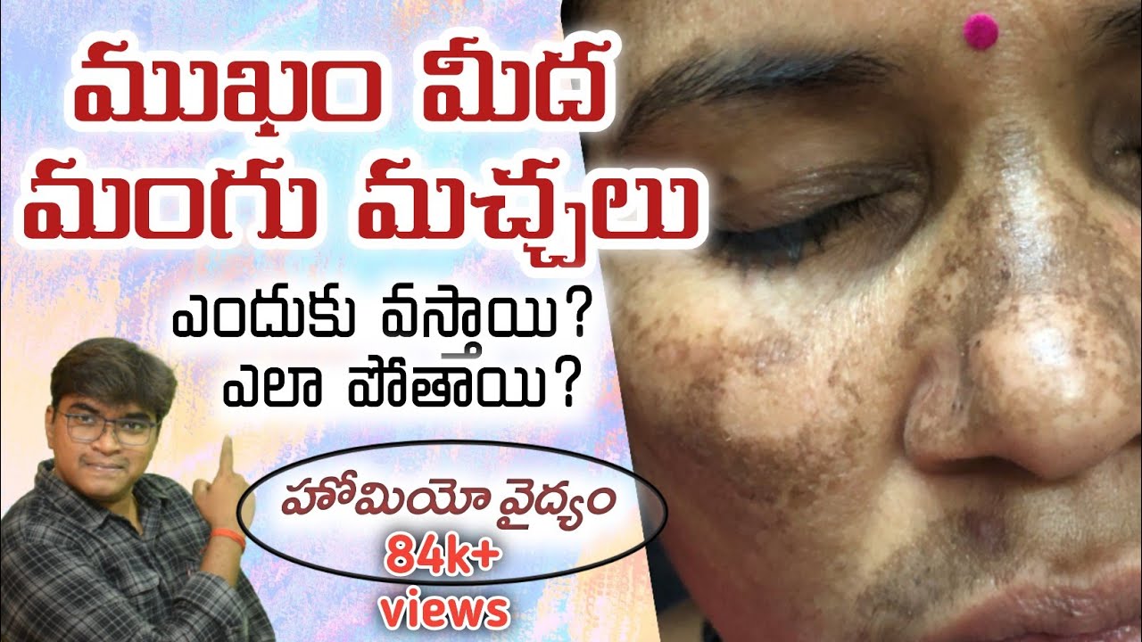 How To Remove Spots On Face At Home Melasma Homeopathy Treatment how-to-remove-spots-on-face-at-home-melasma-homeopathy-treatment