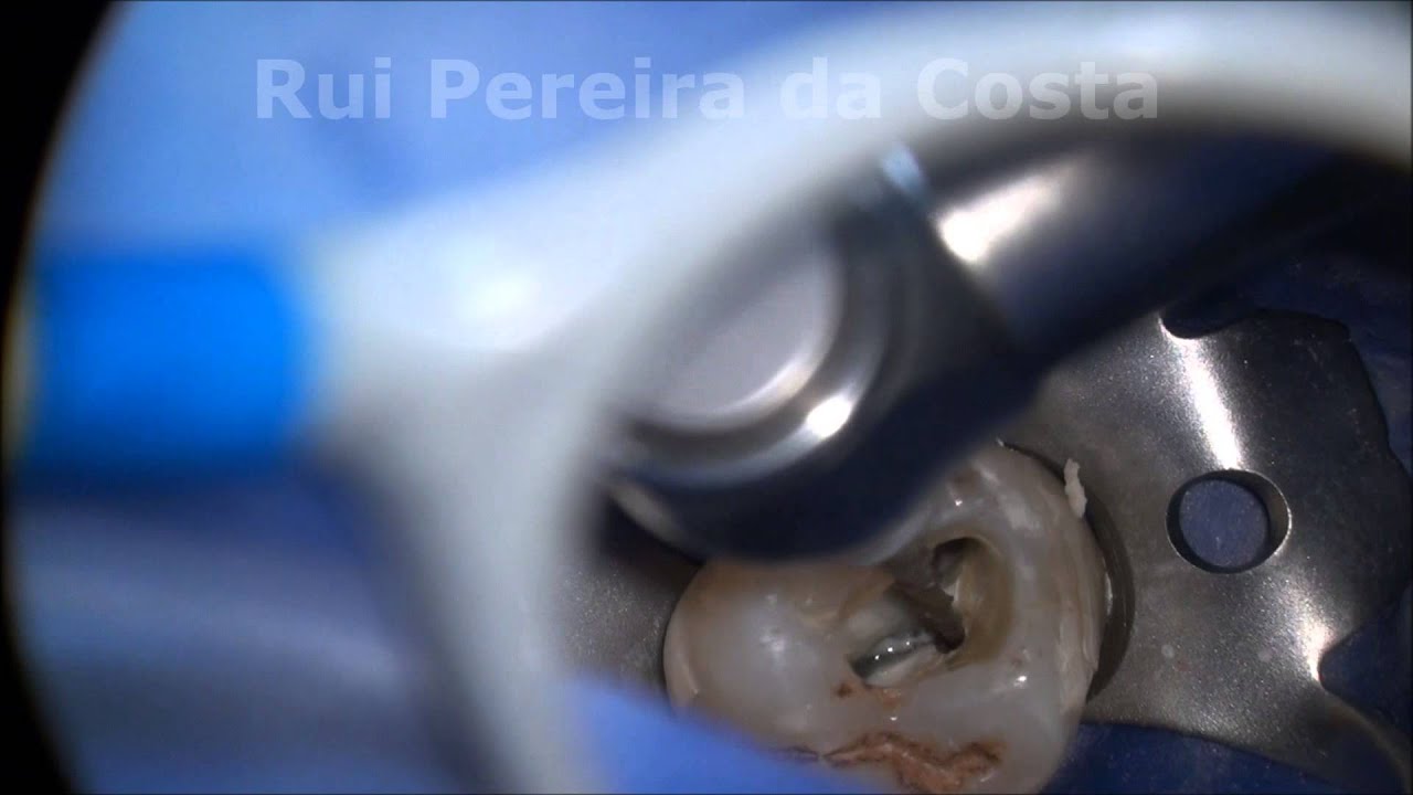 Endodontic Access and Root Canal Preparation in 4 minutes... - YouTube
