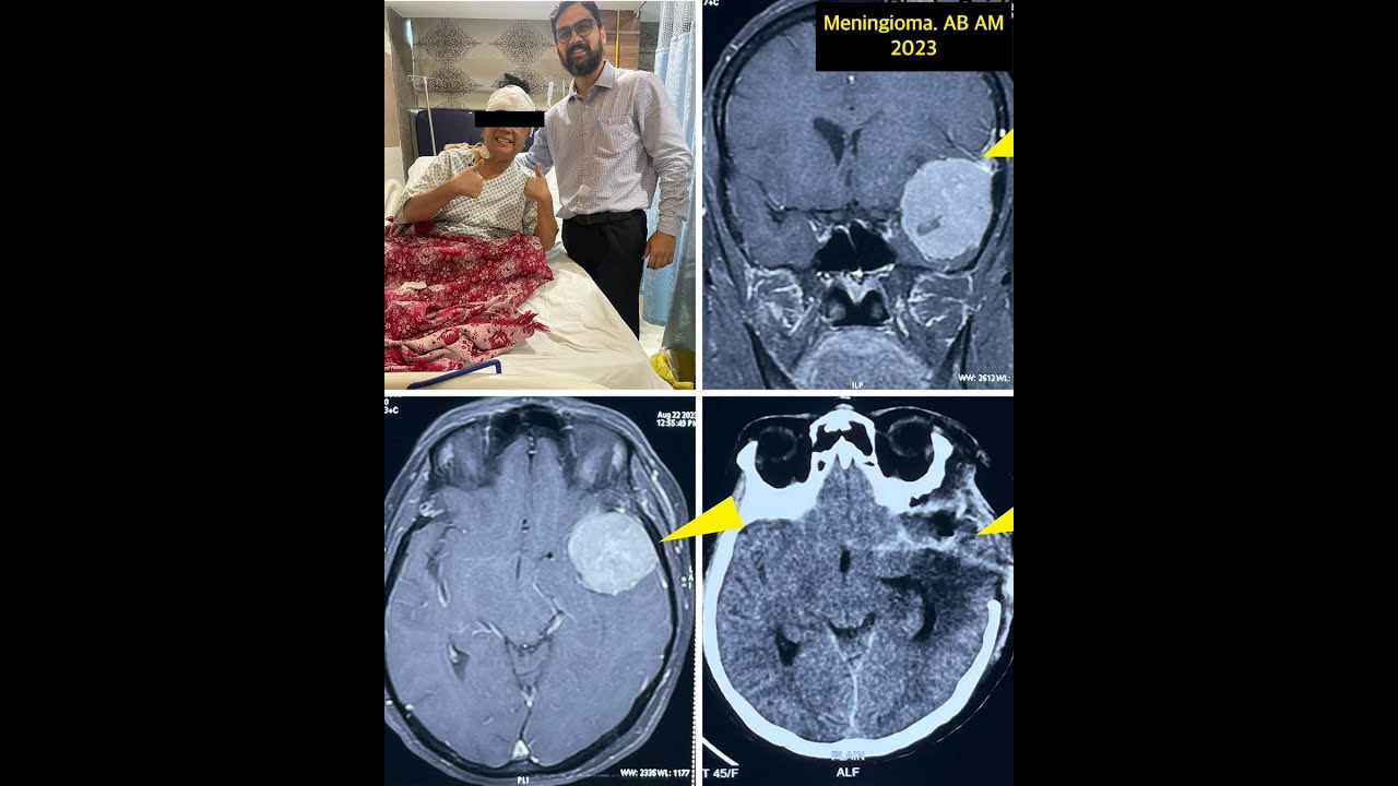 Temporal Meningioma | Convexity | Brain Tumor Excision | Neurosurgery ...