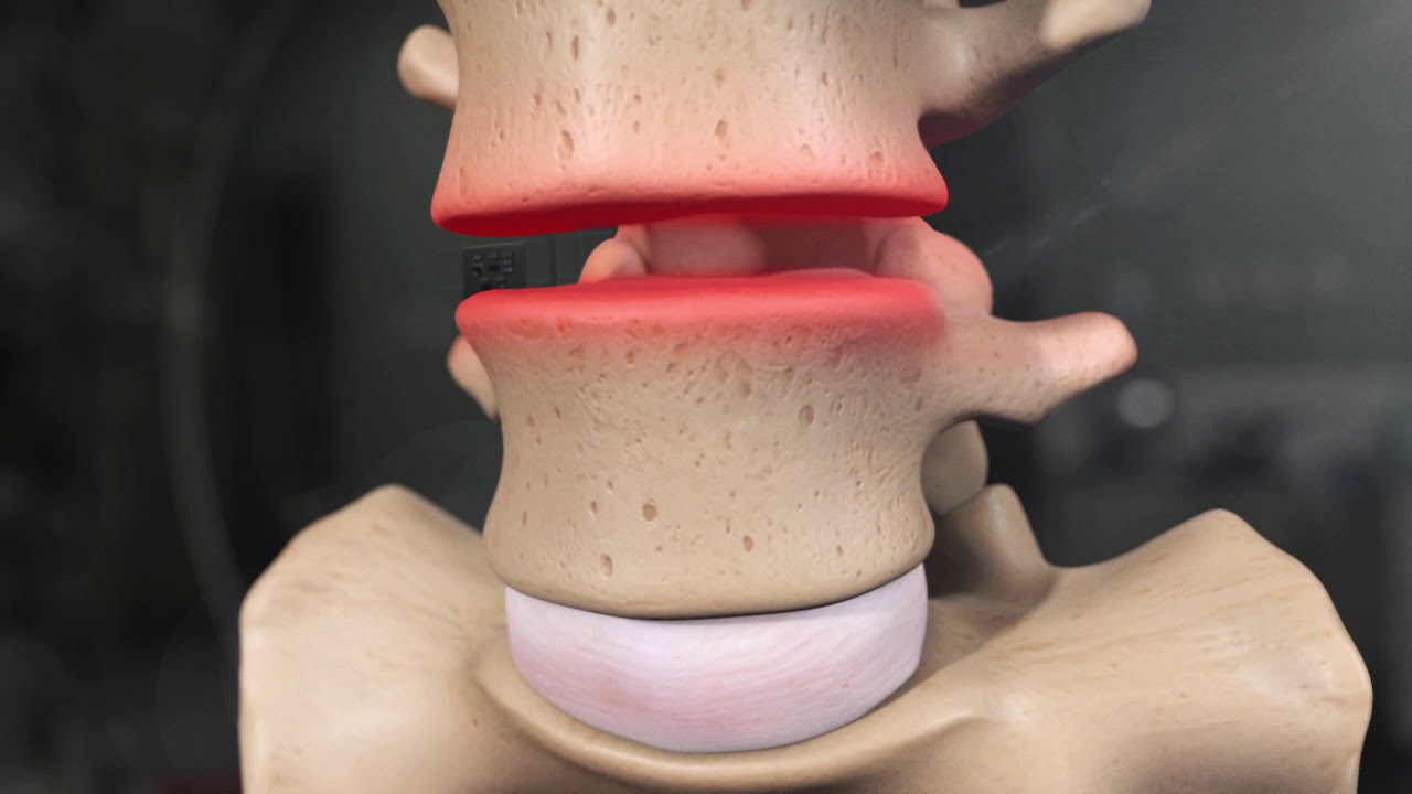 ActivL Disc Replacement - YouTube