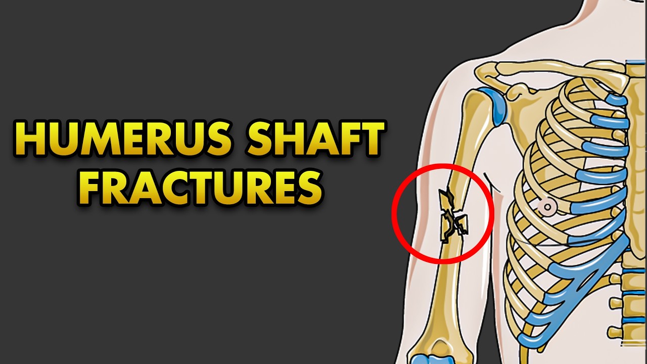 Humerus Shaft Fractures: Clinical Features, Classification, Treatment ...