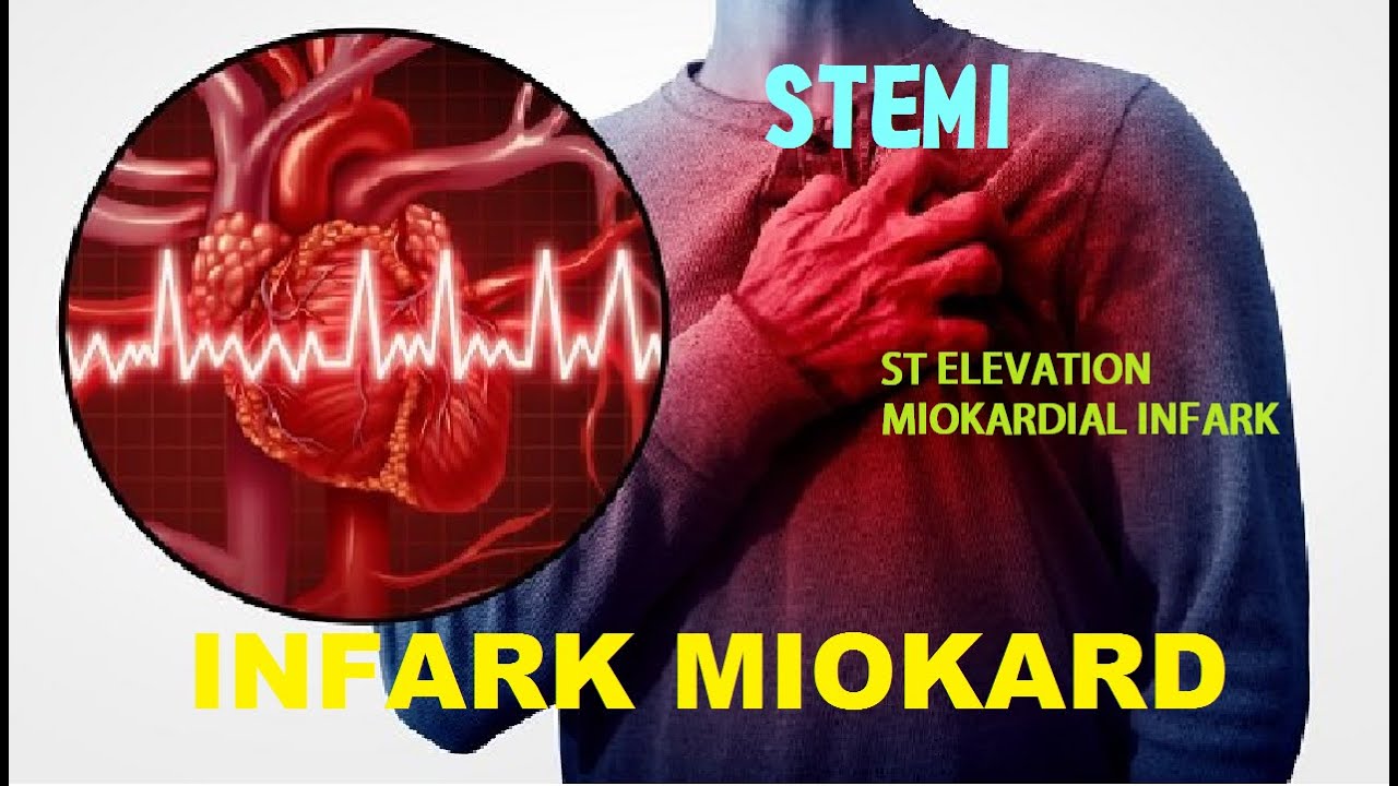 Infark miokardium | STEMI (ST Elevation Miocardial Infark) | Sistem ...