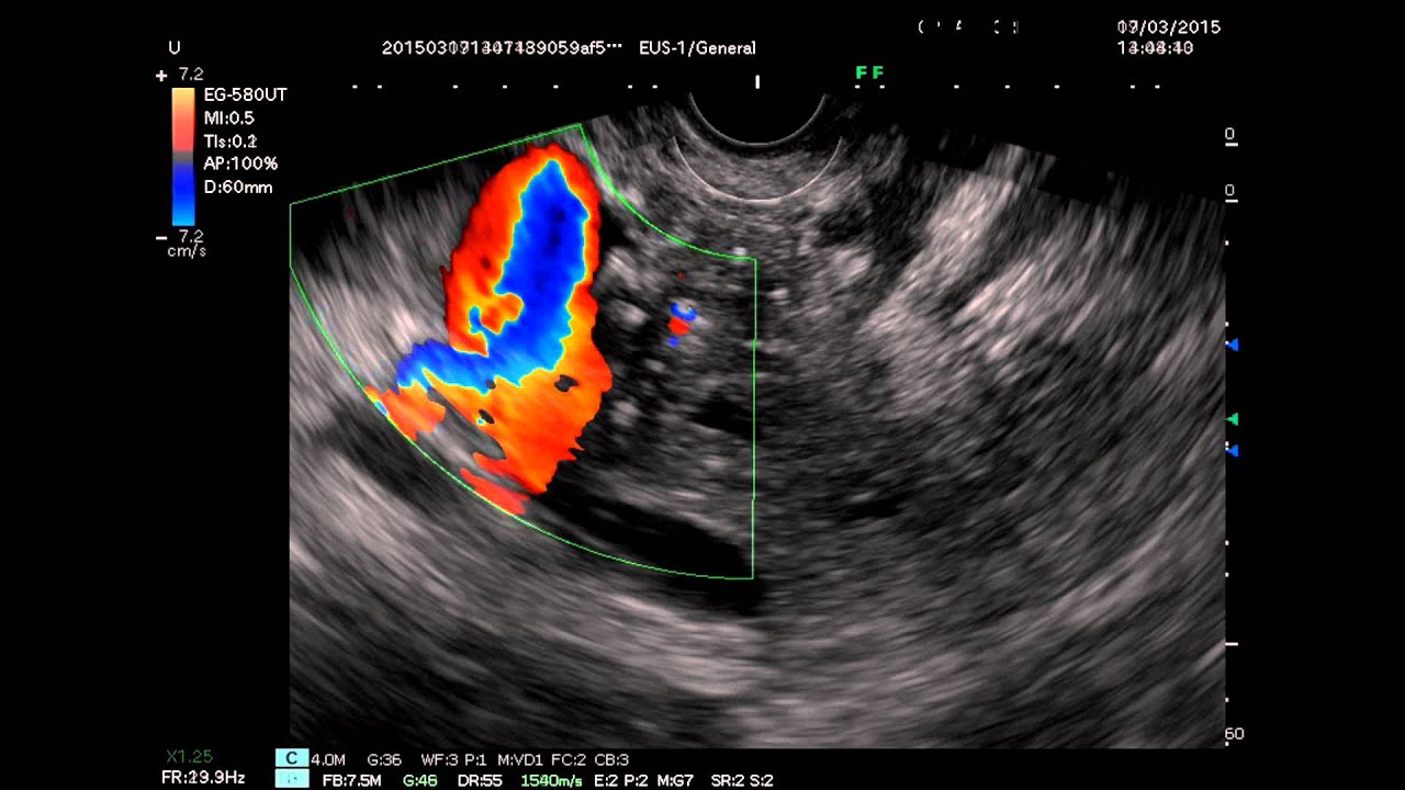 Clinical SU-1 + EG 580UT - YouTube