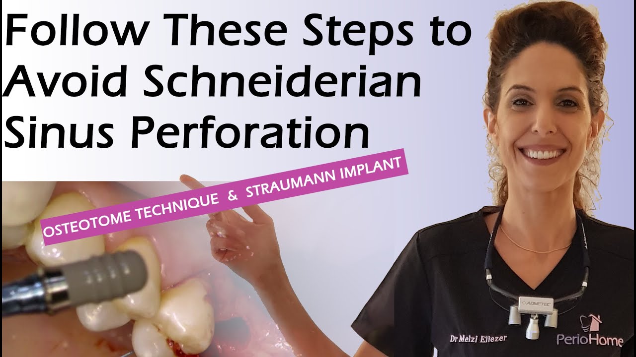 Follow These Steps To Avoid Schneiderian Membrane Perforation during ...