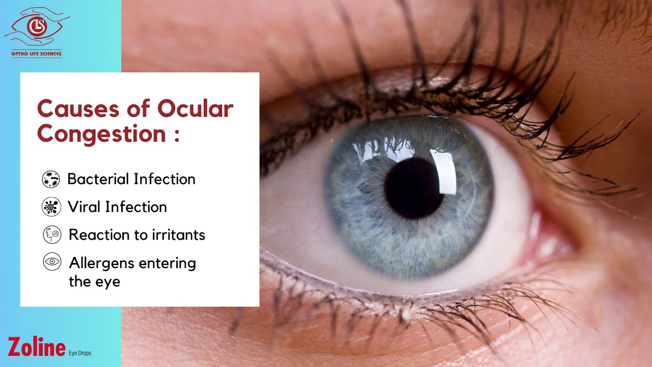 Zoline Plus - for the treatment of Ocular Congestion - YouTube