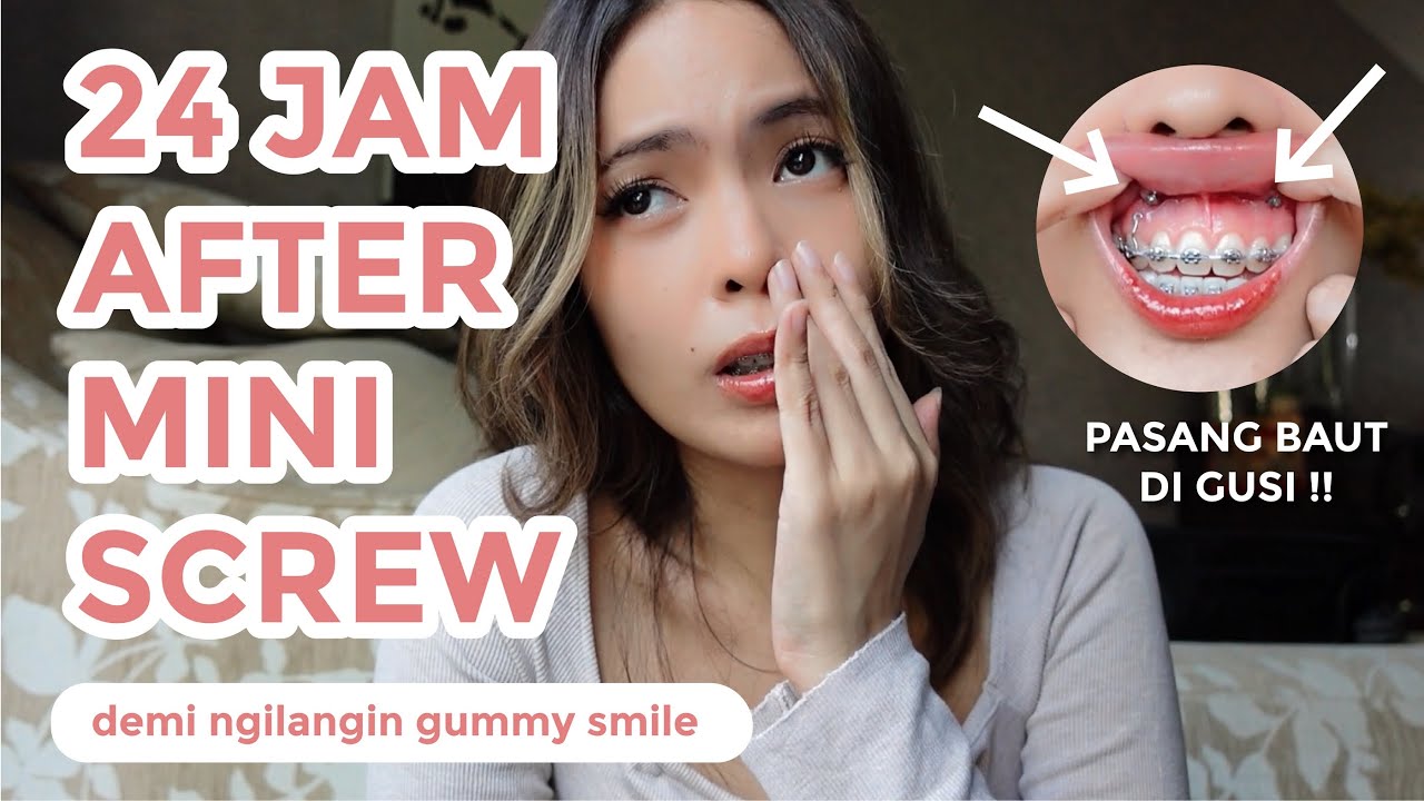 24 JAM AFTER PASANG MINI SCREW BEHEL - NGILANGIN GUMMY SMILE | Braces ...