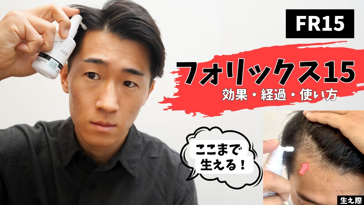 【フォリックス 】FR15の発毛効果と使い方！なぜ『最強の発毛剤』と呼ばれるのか？【再放送】 - YouTube