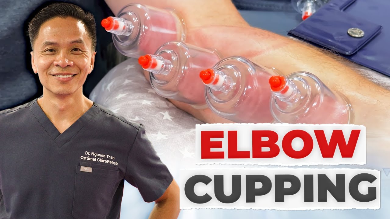 Elbow Cupping: The Technique Used By Dr. Tran to Relieve Elbow Pain ...