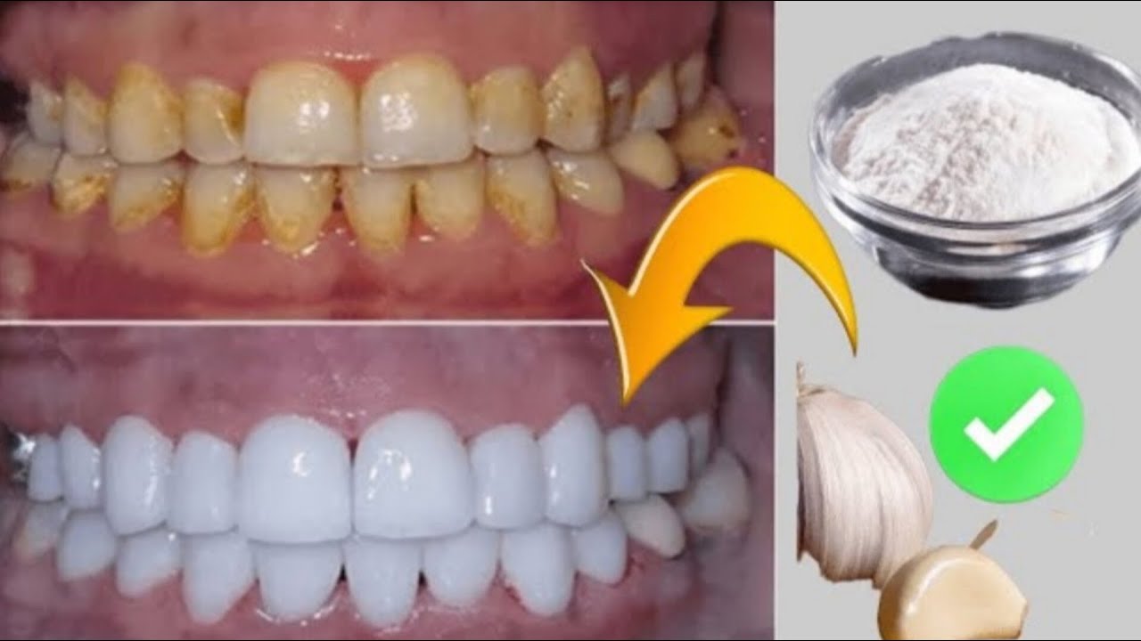 Pearly White Teeth: Natural Way for Teeth Whitening at home,White Teeth ...