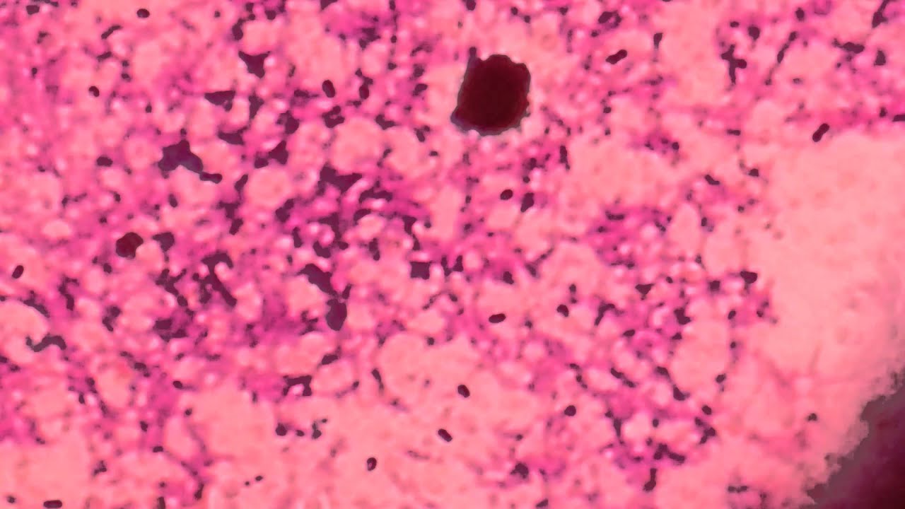 Evidence of Capsule in Gram's stain of Streptococcus pneuminiae from ...