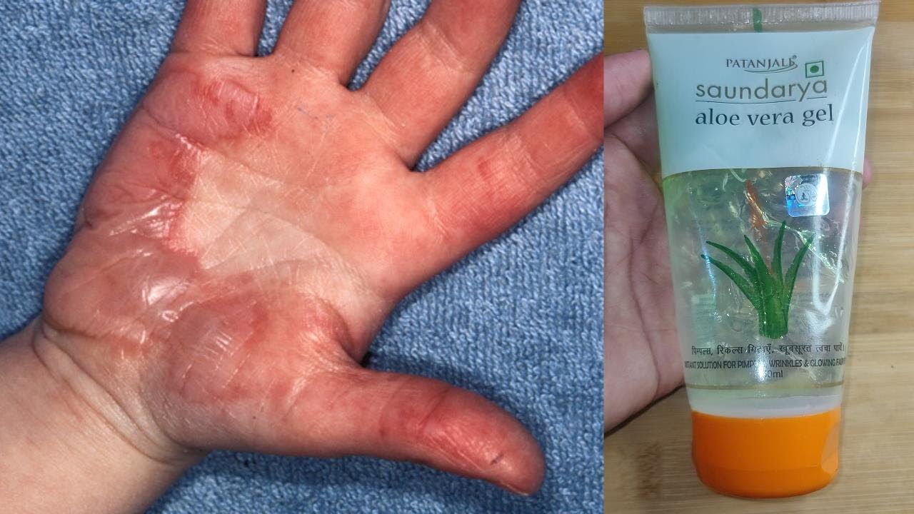 How to Use Aloe Vera for Burns - YouTube