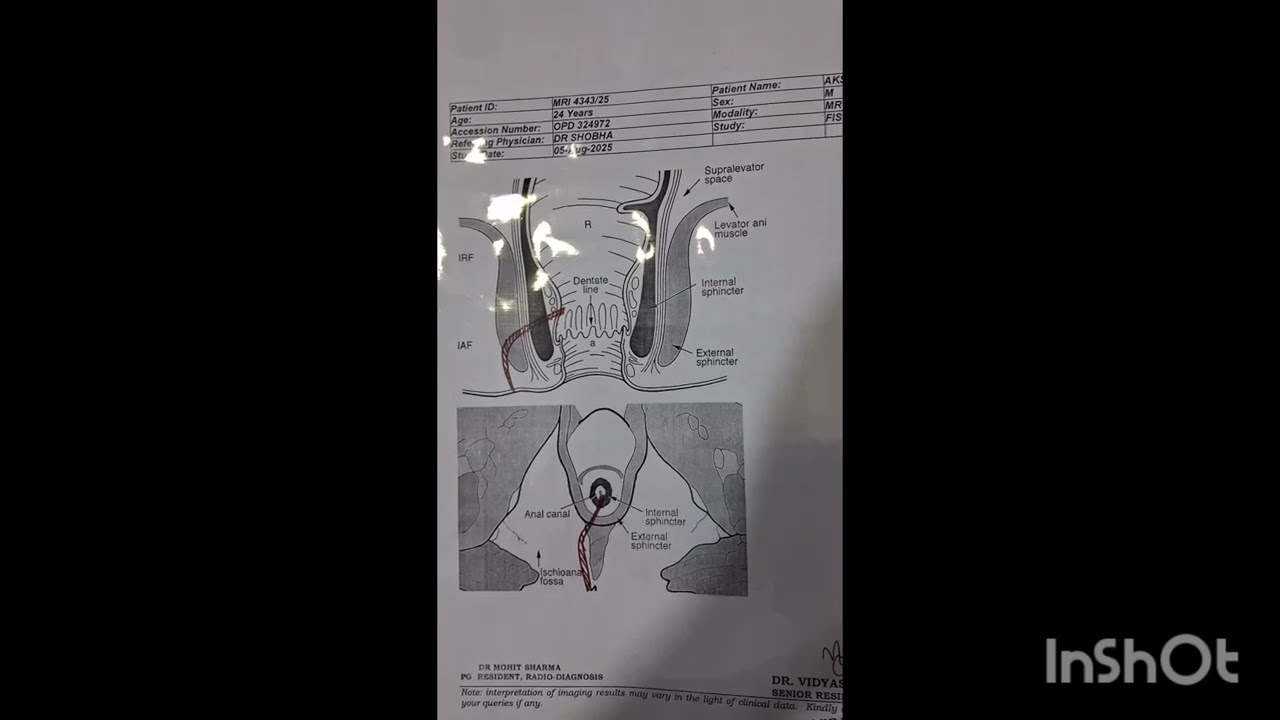 Fistulectomy for an extra lengthy fistula. - YouTube