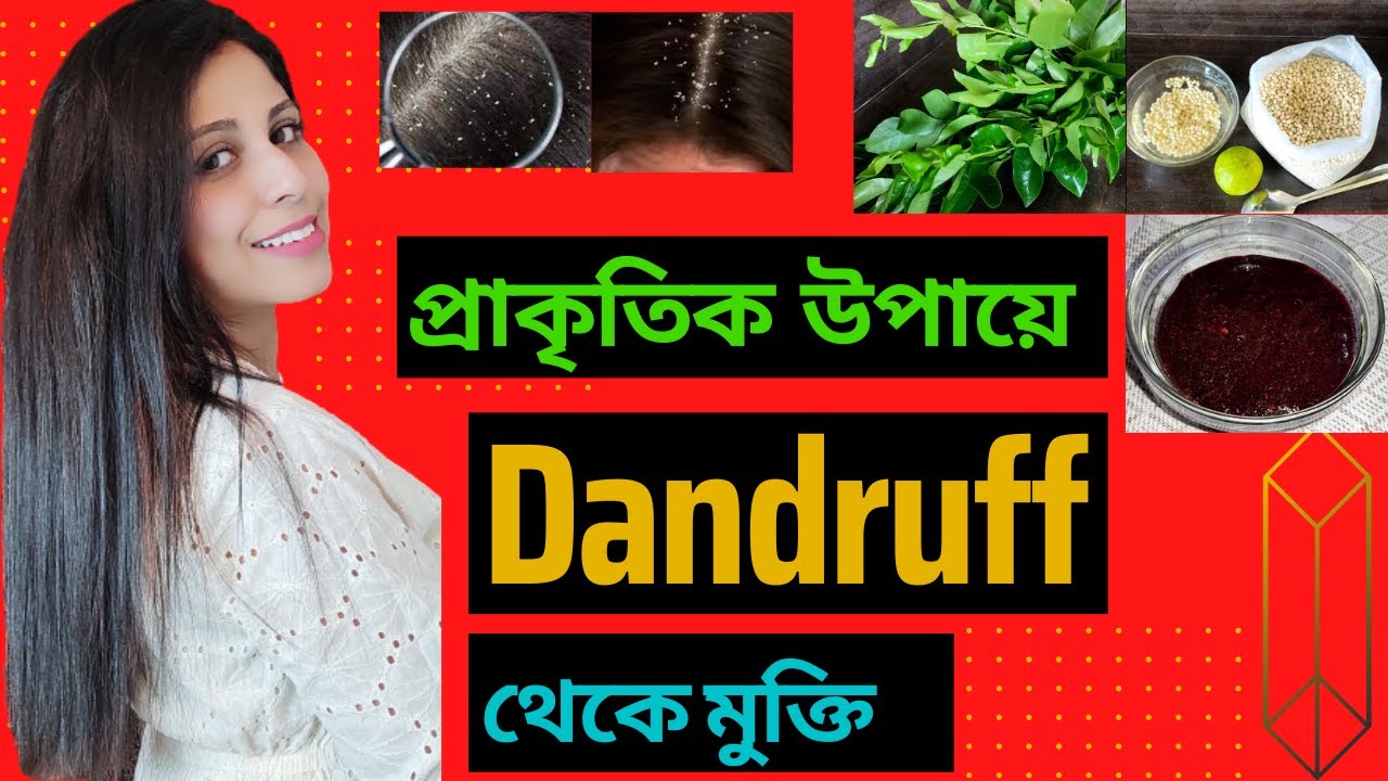 How to remove Dandruff naturally | Dandruff Treatment at home ...
