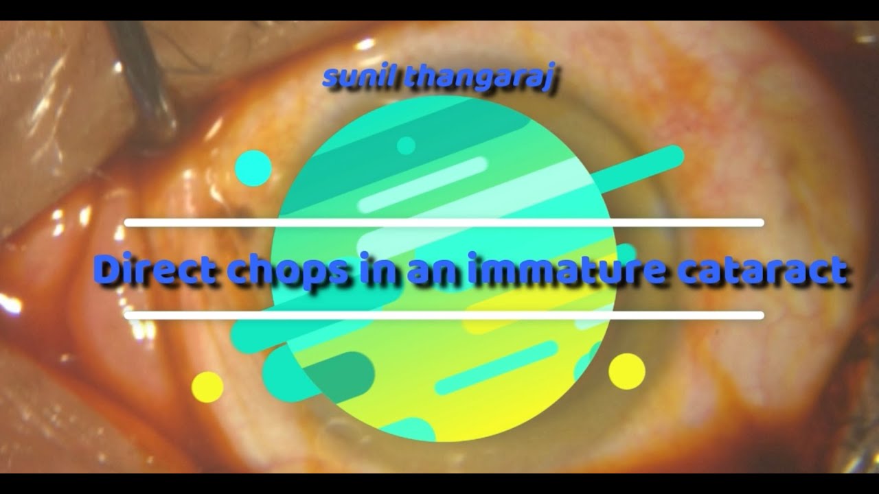 Routine phaco using direct vertical chops - YouTube