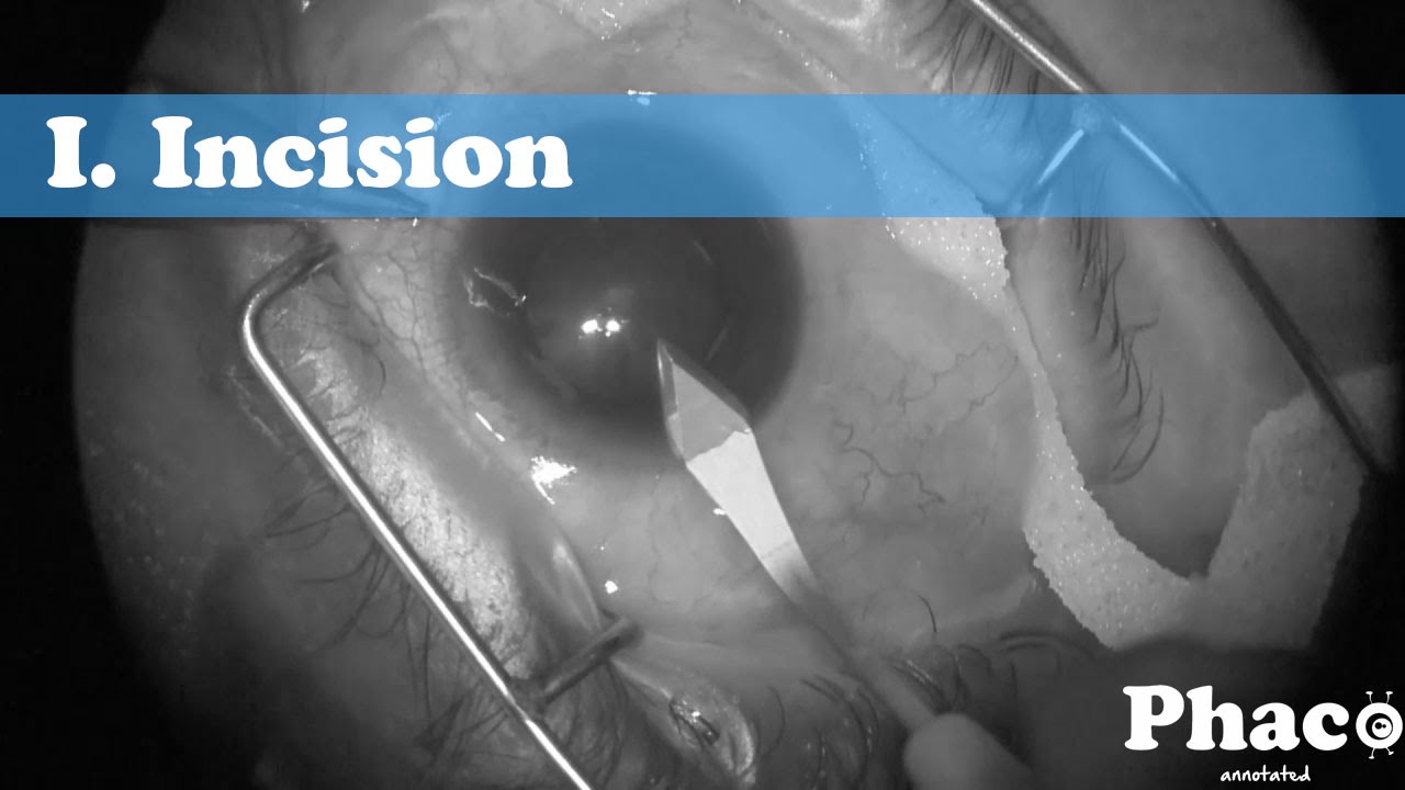 Phaco Annotated | I. Incision - YouTube