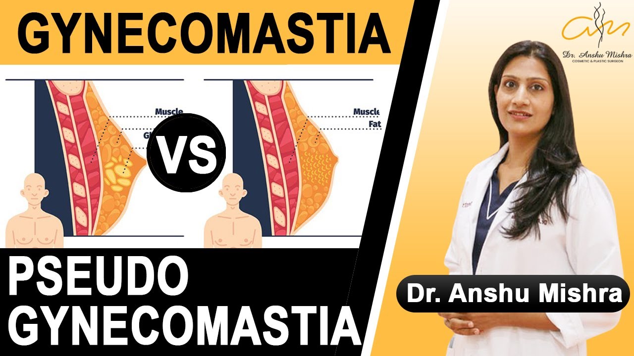 Difference Between Gynecomastia And Pseudo Gynecomastia | Causes ...