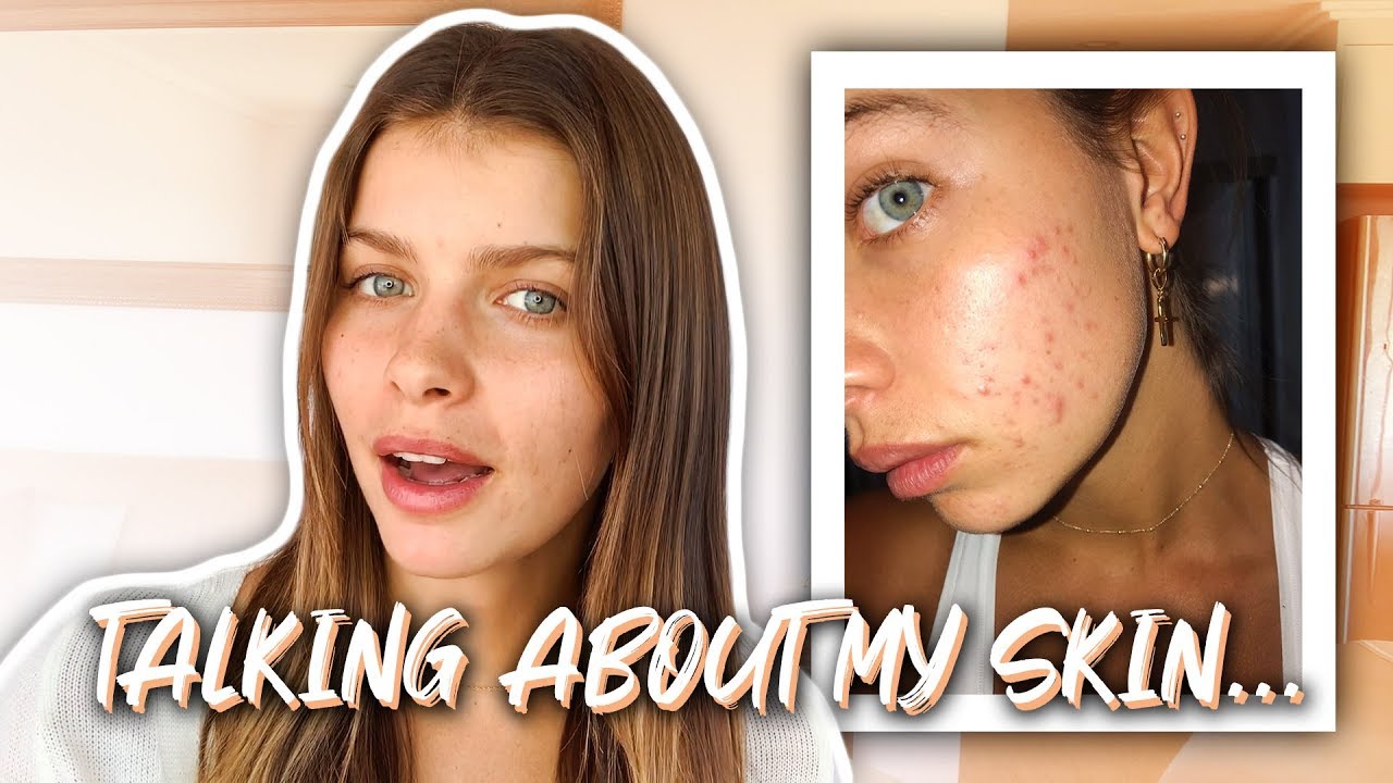 TALKING ABOUT MY SKIN - YouTube