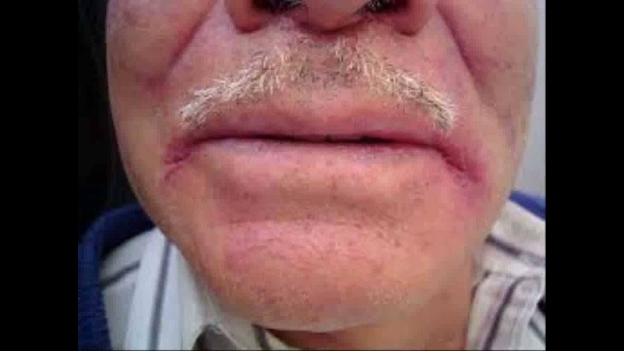 CAUSAS DE LA QUEILITIS ANGULAR Y SUS SÍNTOMAS - YouTube