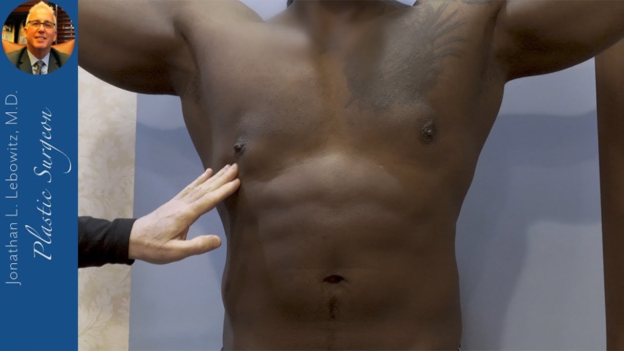 Revision Gynecomastia Hi-Defination VaserLipo Male CHEST Contouring By ...