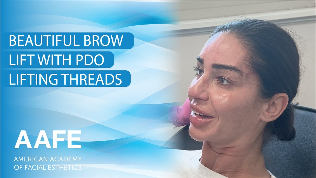 Beautiful Brow Lift with PDO Lifting Threads - YouTube