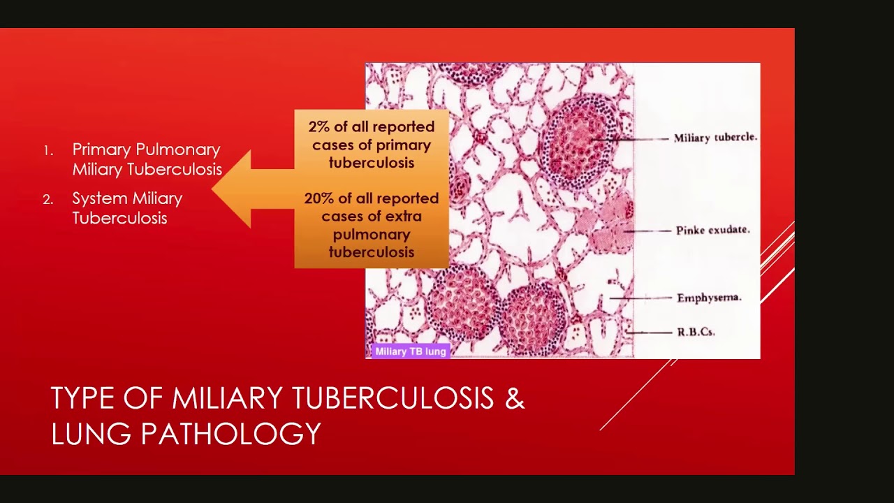 Pathophysiology of Miliary Tuberculosis (5 slides) - YouTube