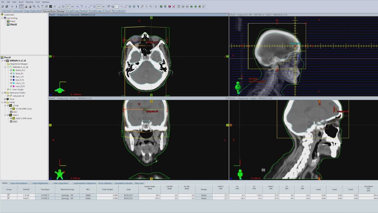 3DCRT Whole Brain Radiation Planning - YouTube