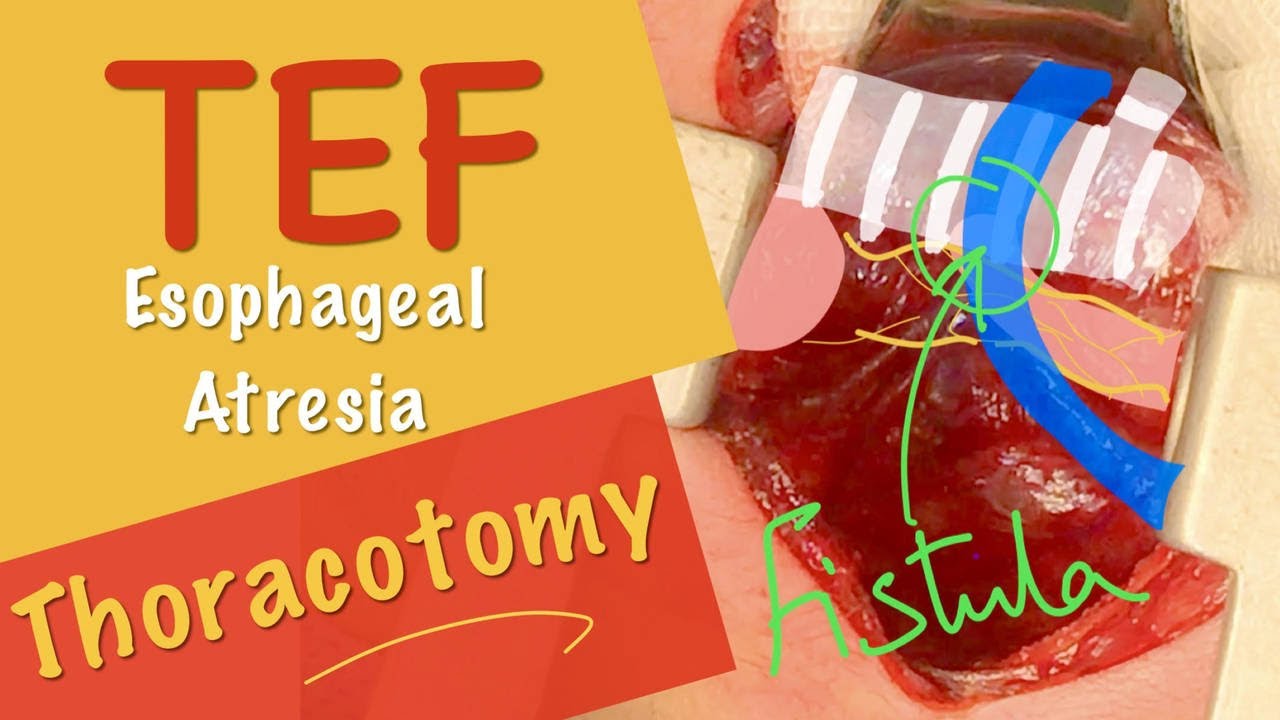 Neonatal Open Repair of Esophageal Atresia & Tracheo-esophageal Fistula ...