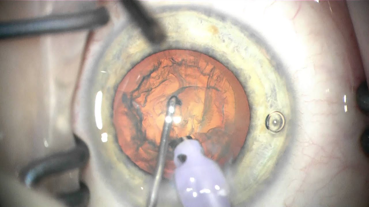 trainee phaco-trabectome in phacomorphic narrow angle glaucoma, s/p ...