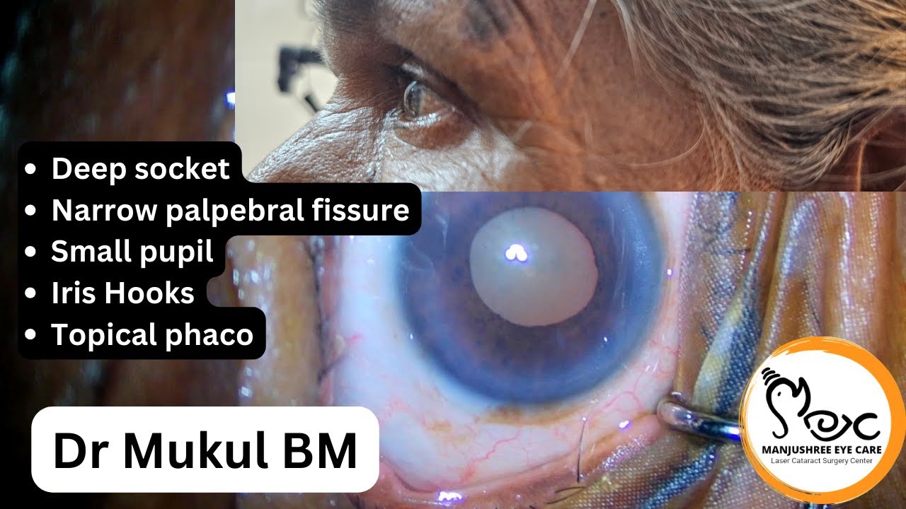 Deep socket |small pupil| Iris Hooks | Topical phacoemulsification - YouTube