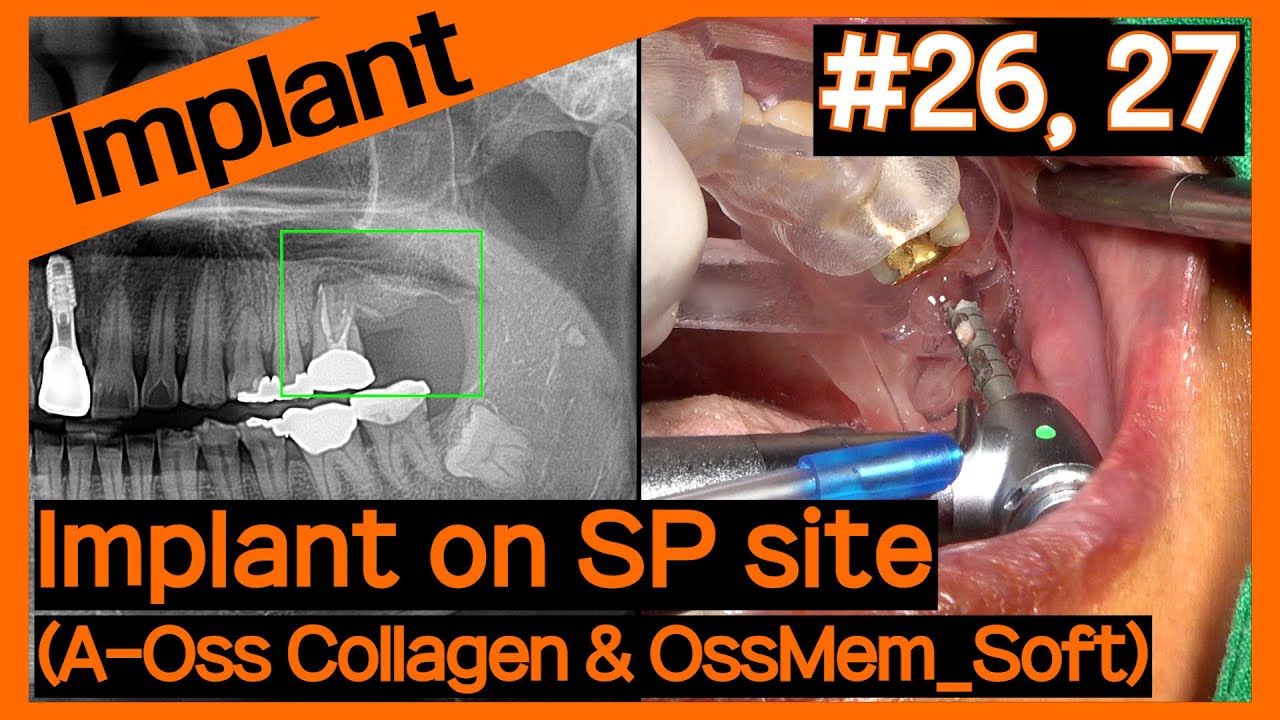 [Online Surgery] Implant after socket preservation using A-Oss Collagen ...