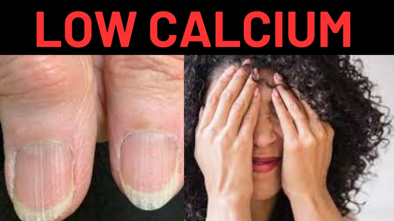 Hypocalcemia Signs, Symptoms, Causes, Treatment - YouTube