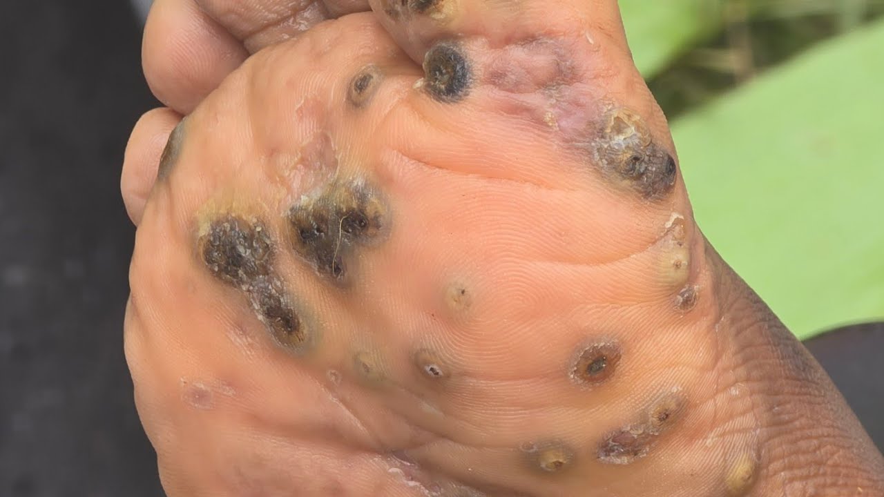 Maxwell Inyambura dejiggering - little body, tough skin with jiggers ...