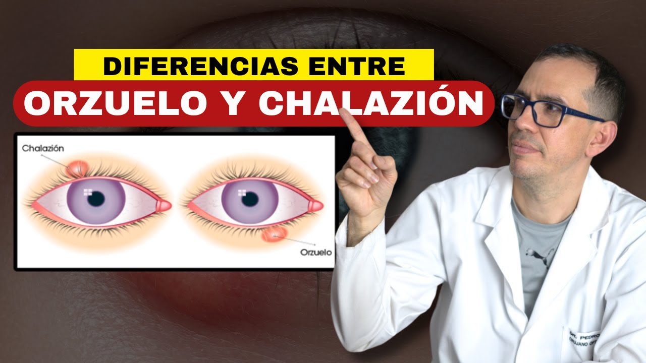 MÉDICO OFTALMÓLOGO EXPLICA DIFERENCIAS ENTRE ORZUELO Y CHALAZIÓN ...