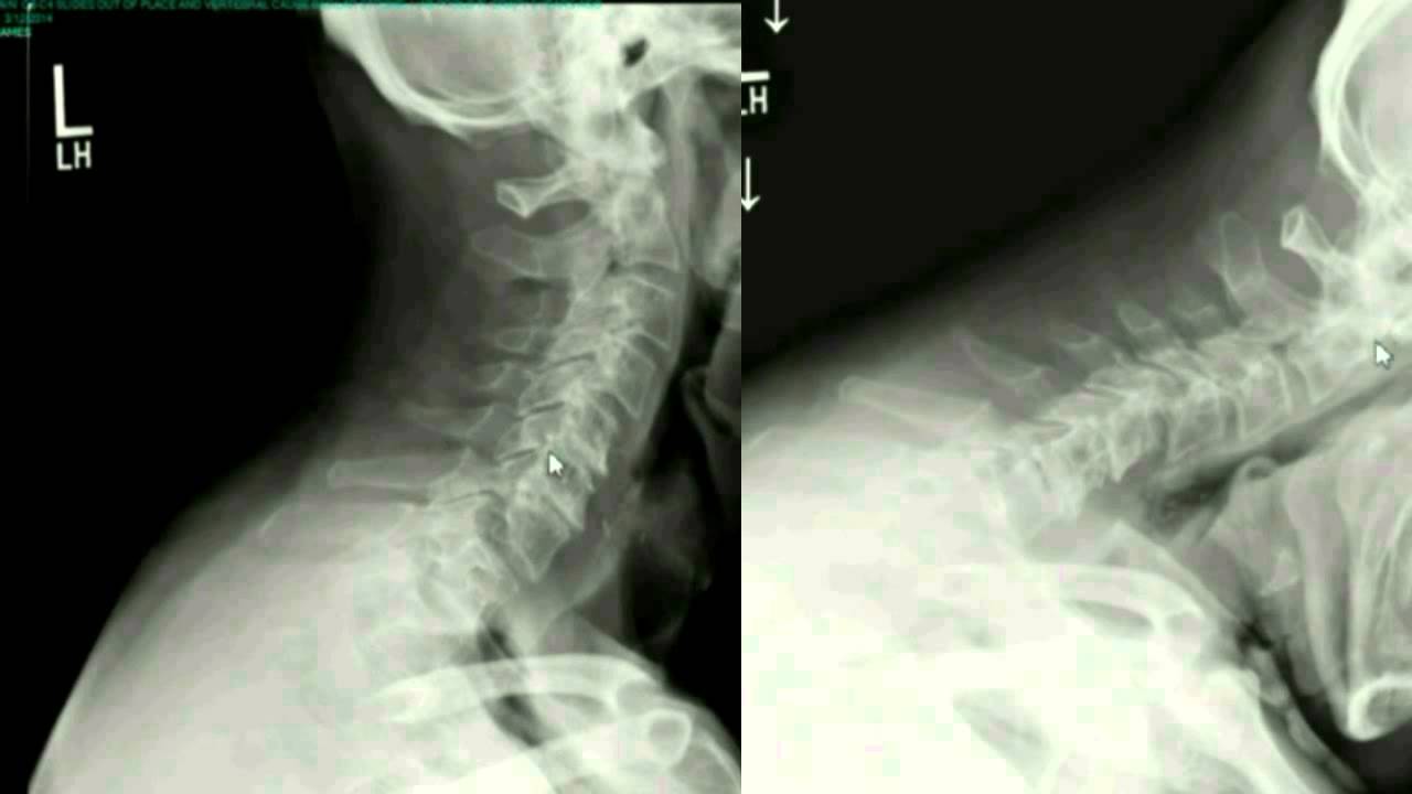 My Messed up Neck - YouTube