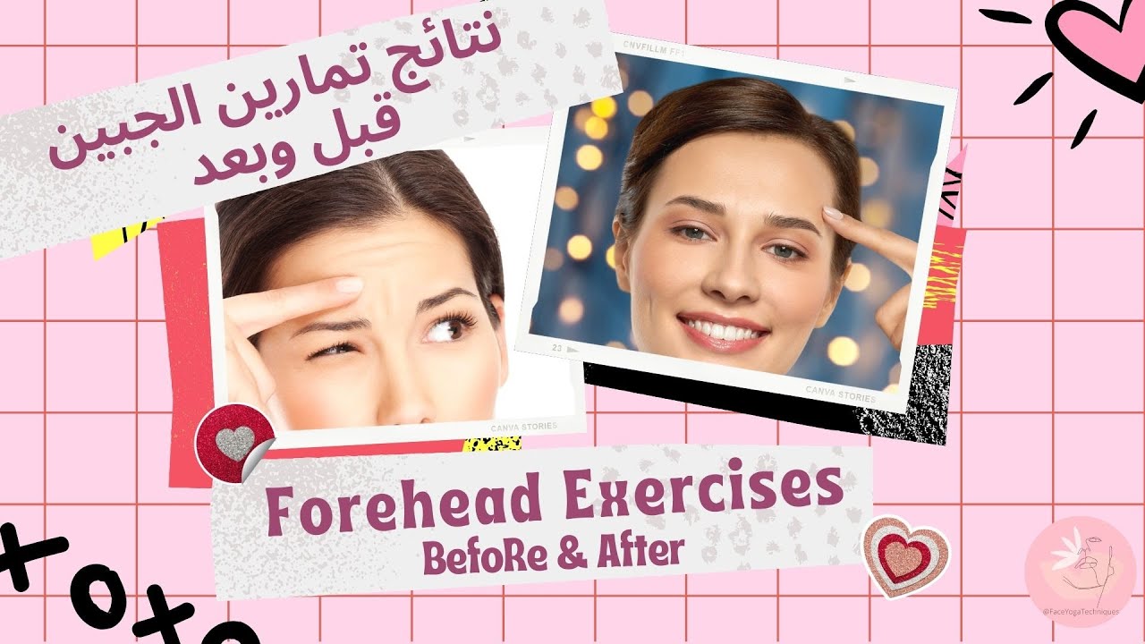 Forehead Exercises Results! Before and After Pictures | نتائج تمارين ...