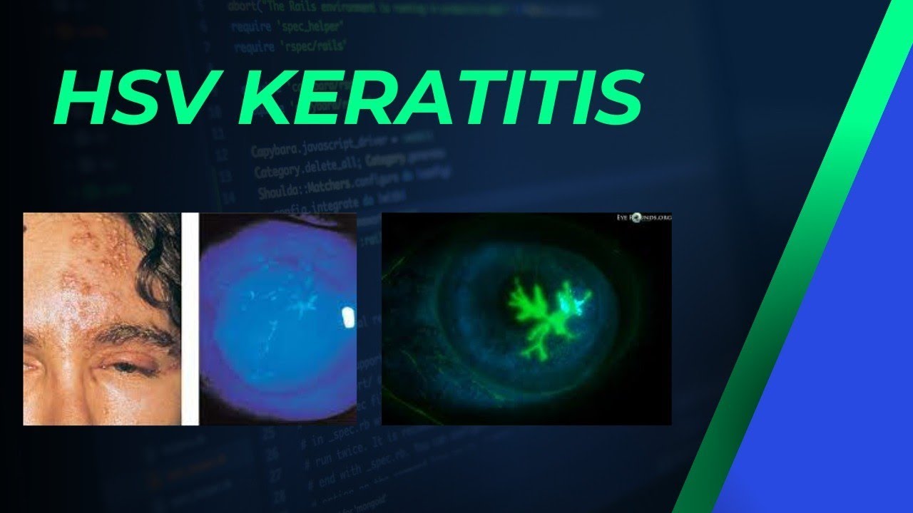 HSV Keratitis | Causes , Symptoms , Diagnosis , Treatment & Pathology ...