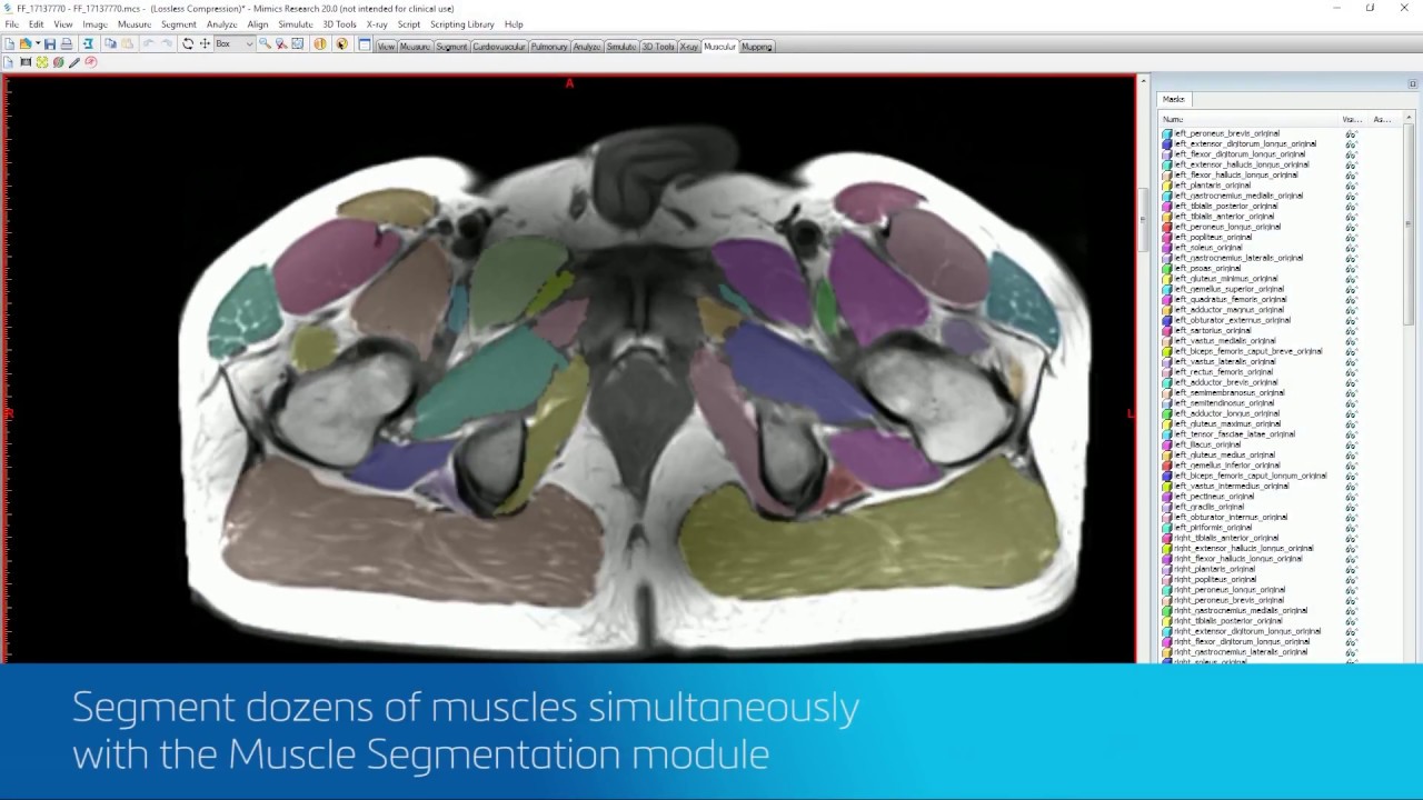 Medical Image Segmentation Made More Intuitive | Mimics Innovation ...