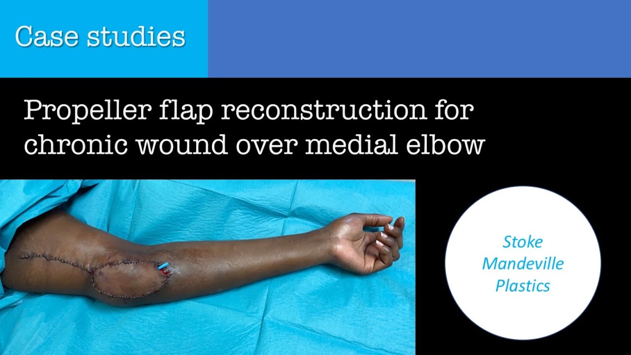 Brachial artery perforator flap reconstruction for elbow wound - YouTube