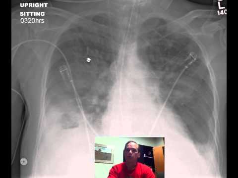 CHF CXR x2 Findings Discussed by Radiologist - YouTube