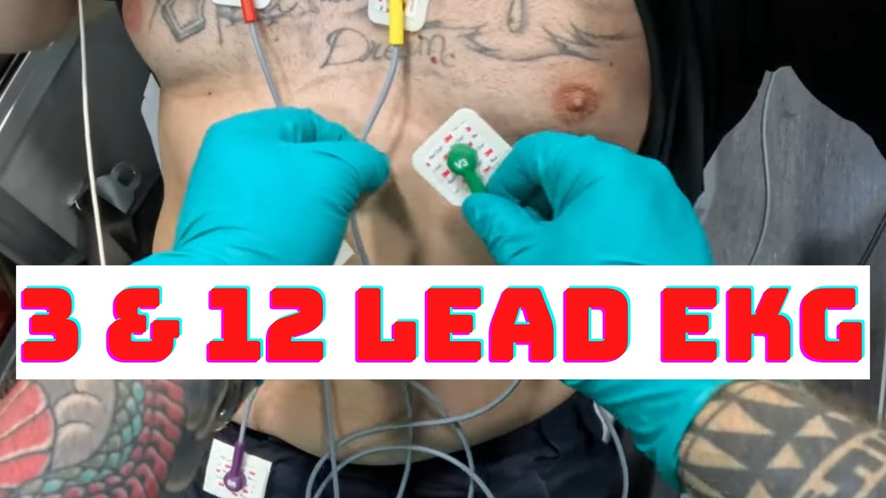 How to acquire 3 and 12 Lead EKG on LifePak 15? - YouTube